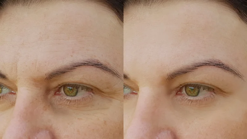 Illuma Sculpt Facial | Treatment | The Éterne Clinic